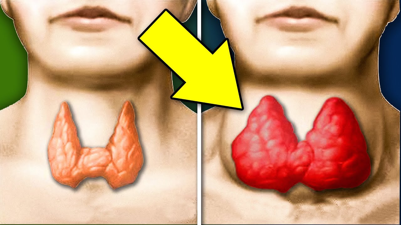 Враги Щитовидки! 9 ошибок которые Разрушают вашу Щитовидную железу ...