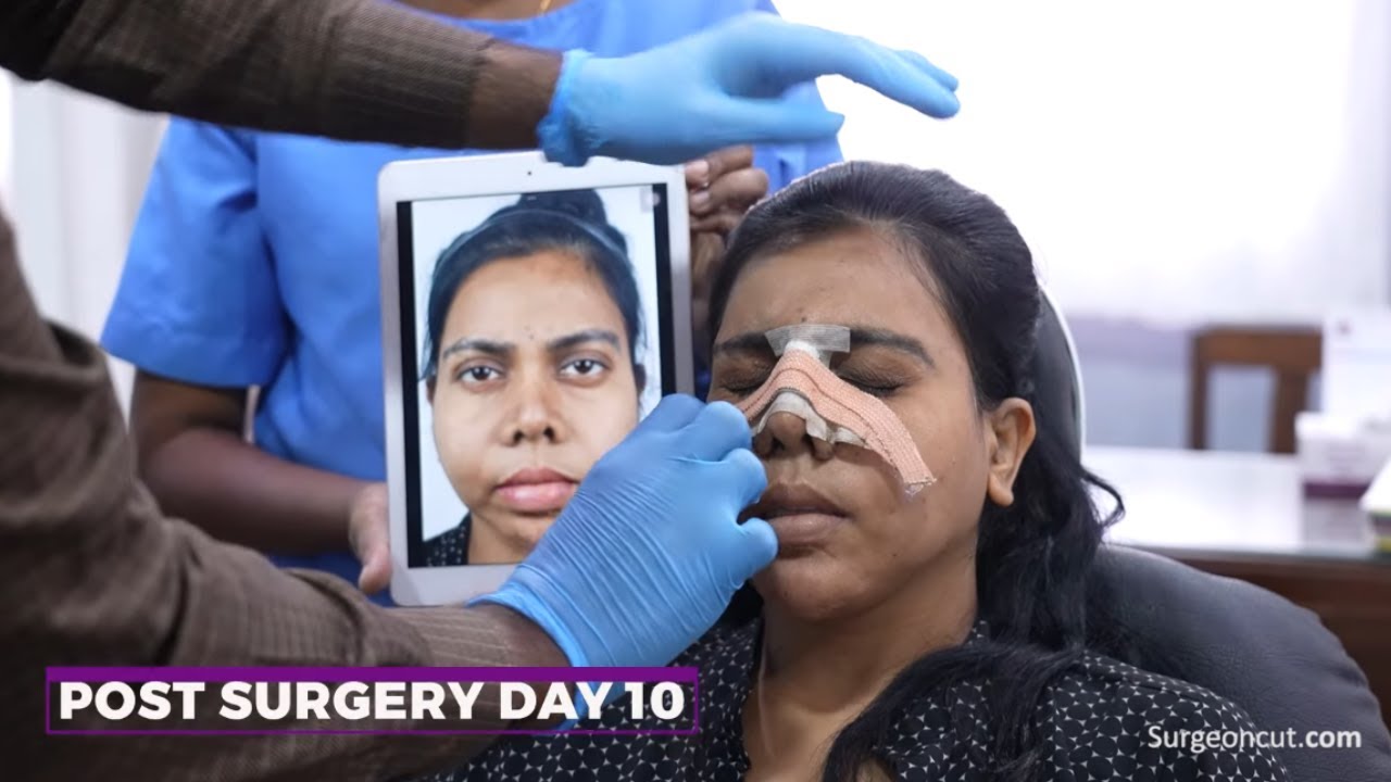 Nasal Splint Removal After Nose Job - Before & After Results - YouTube