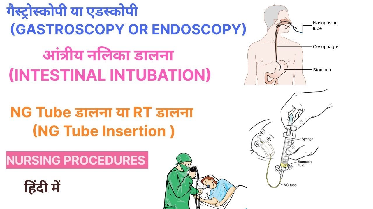 Gastroscopy oR Endoscopy ll Intestinal intubation ll NG tube insertion ...