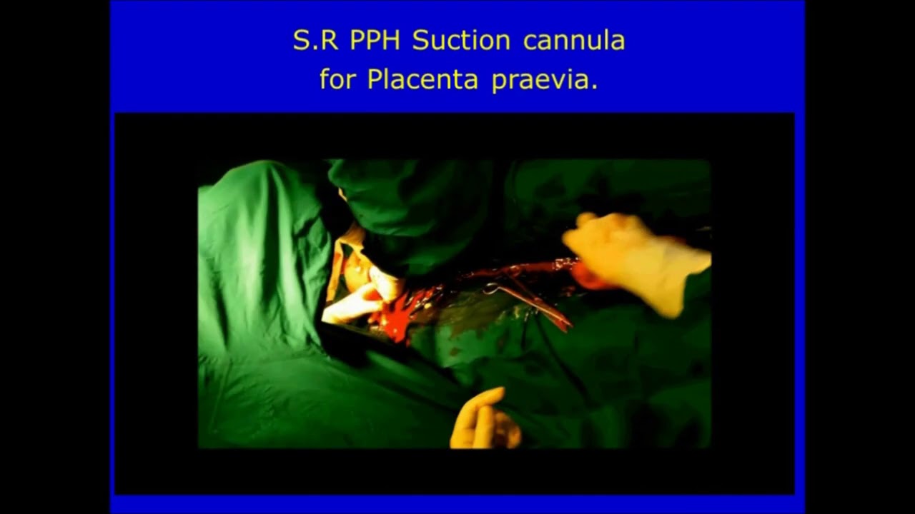 SR Cannula for Placenta Praevia - YouTube