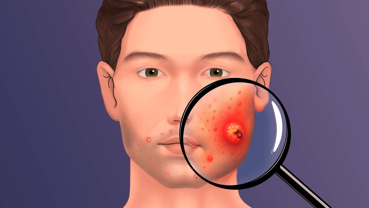 ASMR Satisfying Facial Shaving Animation | Deep Ingrown Hair Removal ...