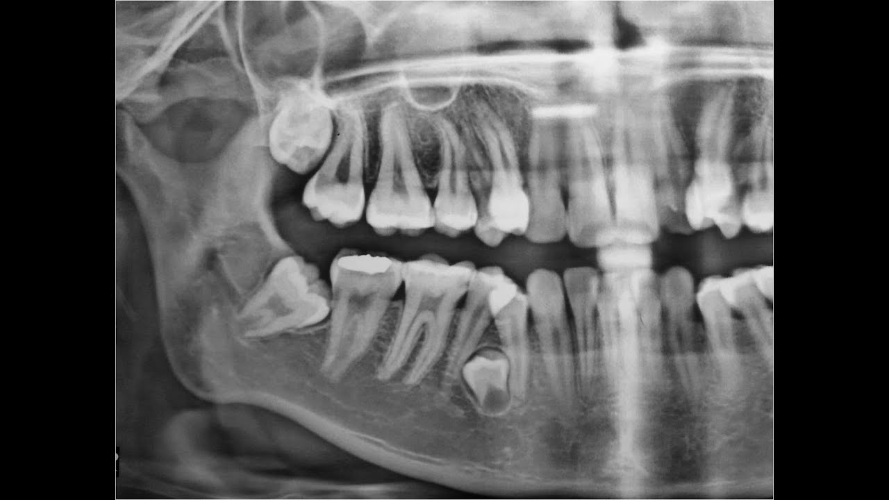 Surgical Management of Impacted Extra Premolar Case By Dr. Akash ...