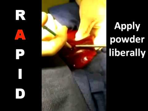 HemaBlock Hemostatic Powder RAPID procedure instructions - YouTube