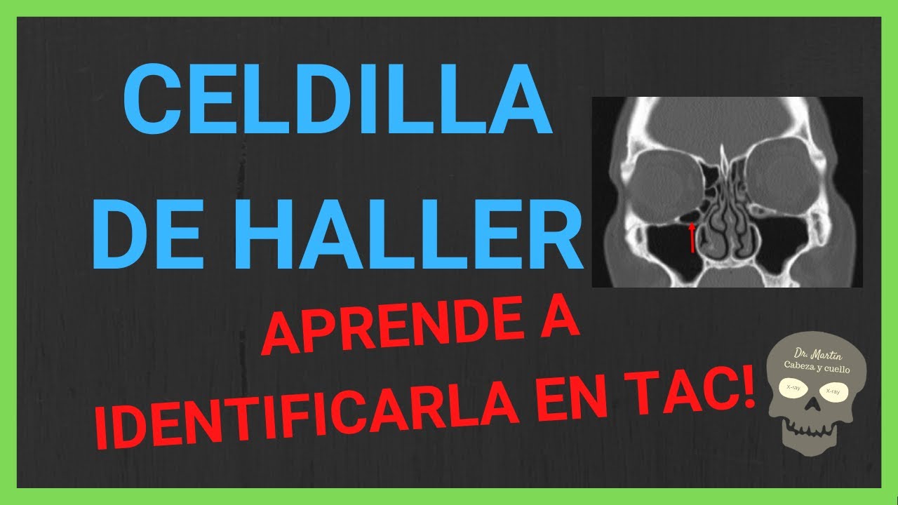 CELDILLA DE HALLER (tomografía) - YouTube