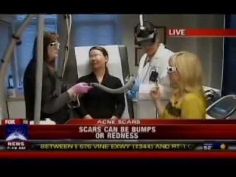 Fraxel & Perfecta/Smoothbeam Laser treatments with Dr. Eric Bernstein ...