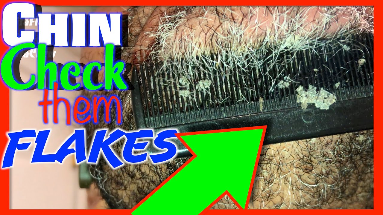 BEARD DANDRUFF & EYEBROW | SEBORRHEIC DERMATITIS | PitaFlakes - YouTube