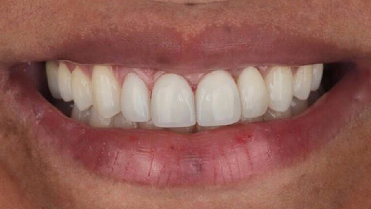 Qual Melhor PPR Prótese Dentária Parcial Removível Ou Fixa de Protocolo ...