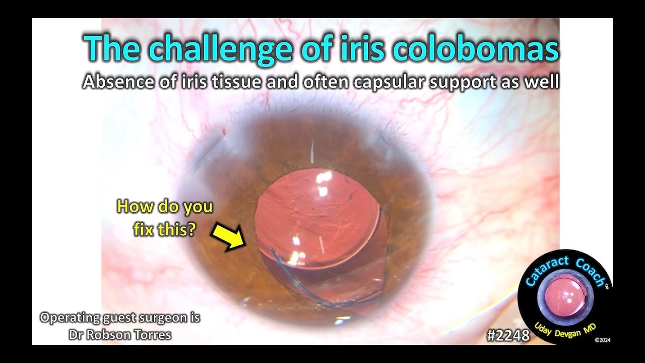 CataractCoach™ 2248: the challenge of iris colobomas - YouTube