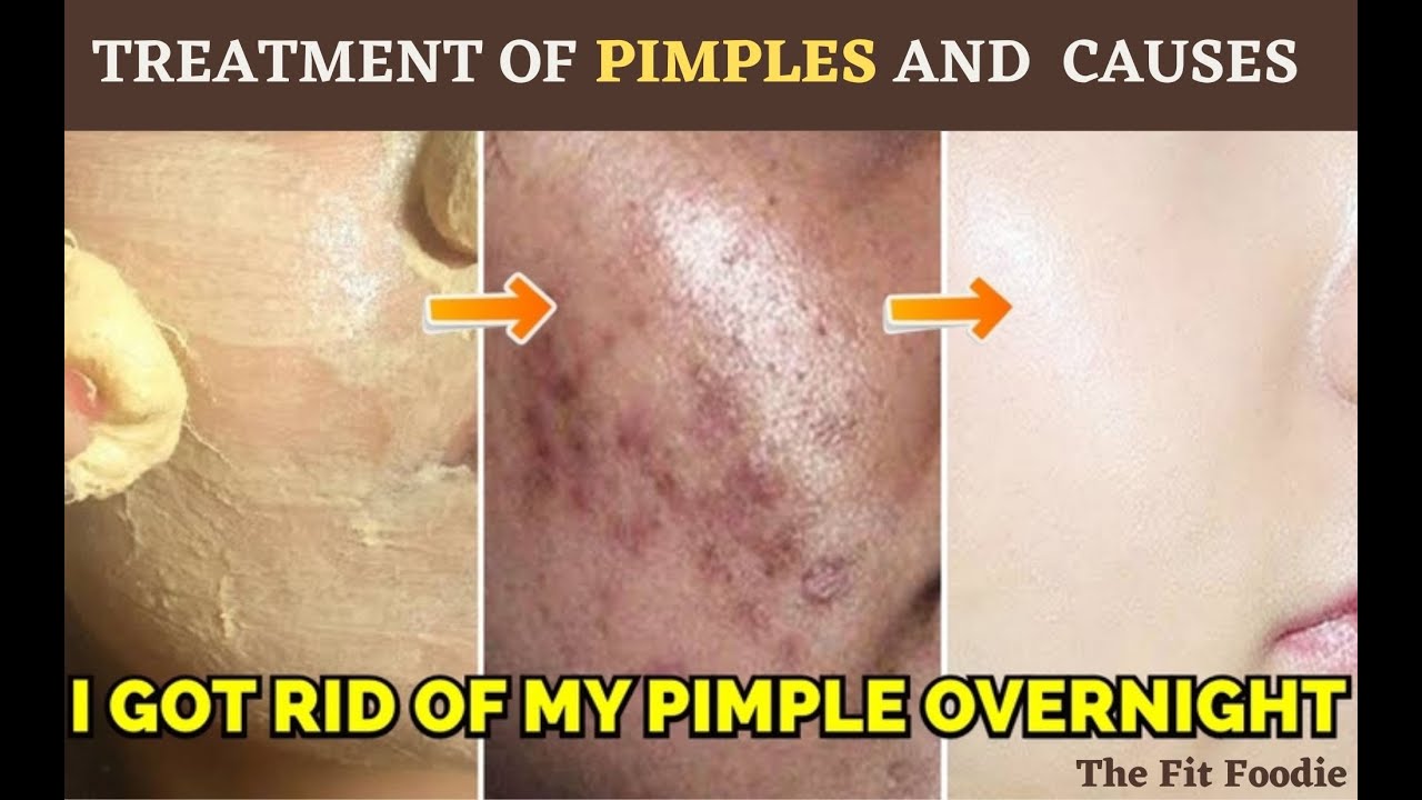 Cure Pimple (Acne) Overnight | 1-Night Solution (Simple & Easy) - YouTube