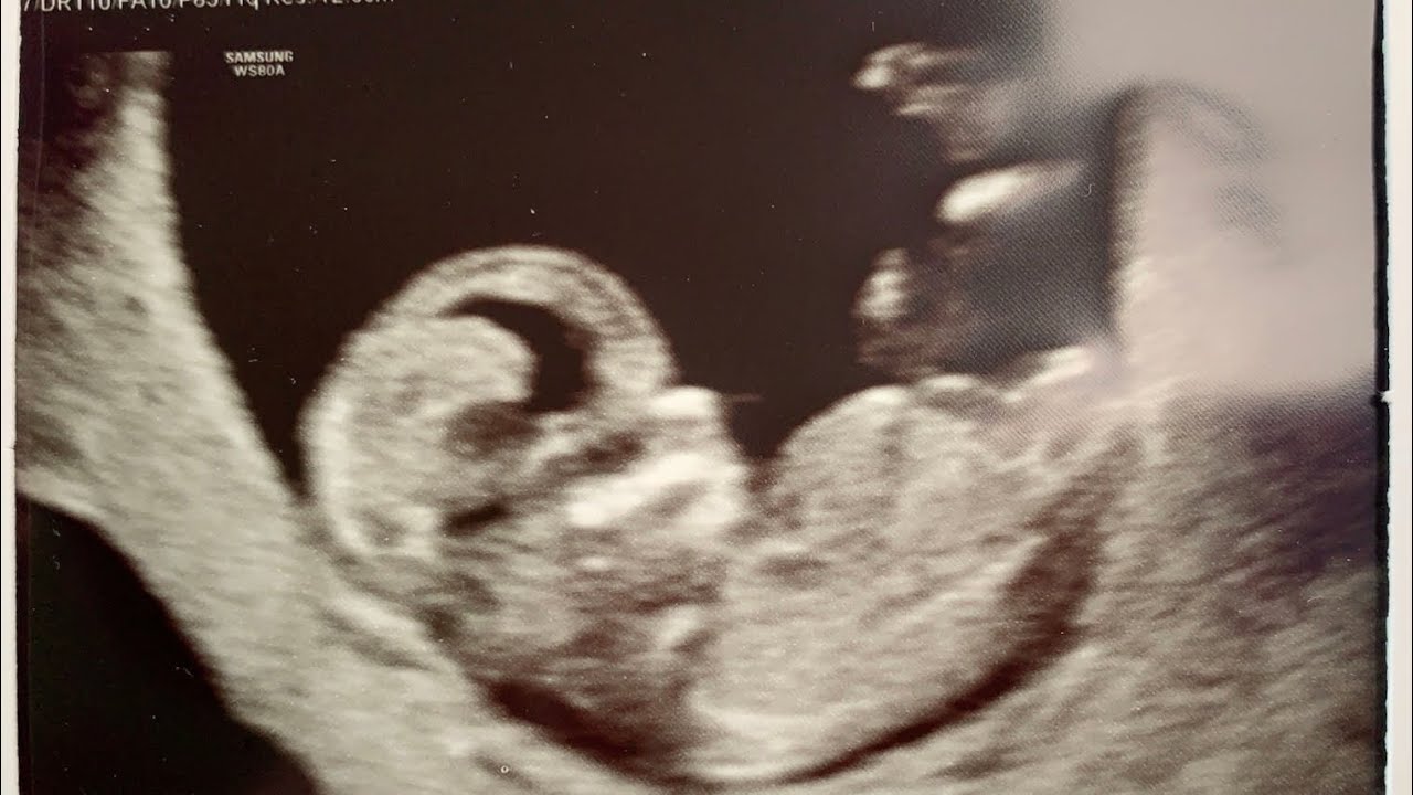 12 weeks - 15 weeks - YouTube