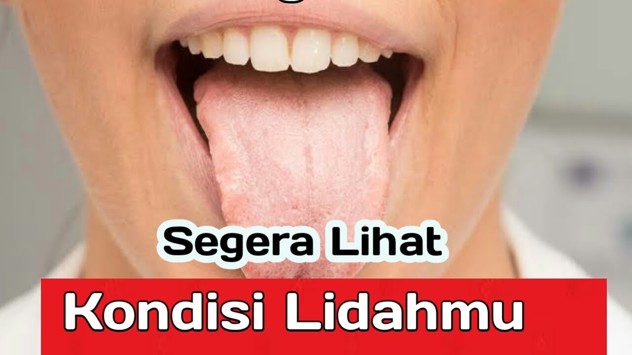Cara Membedakan Lidah Yang Sehat dan yang Tidak - YouTube