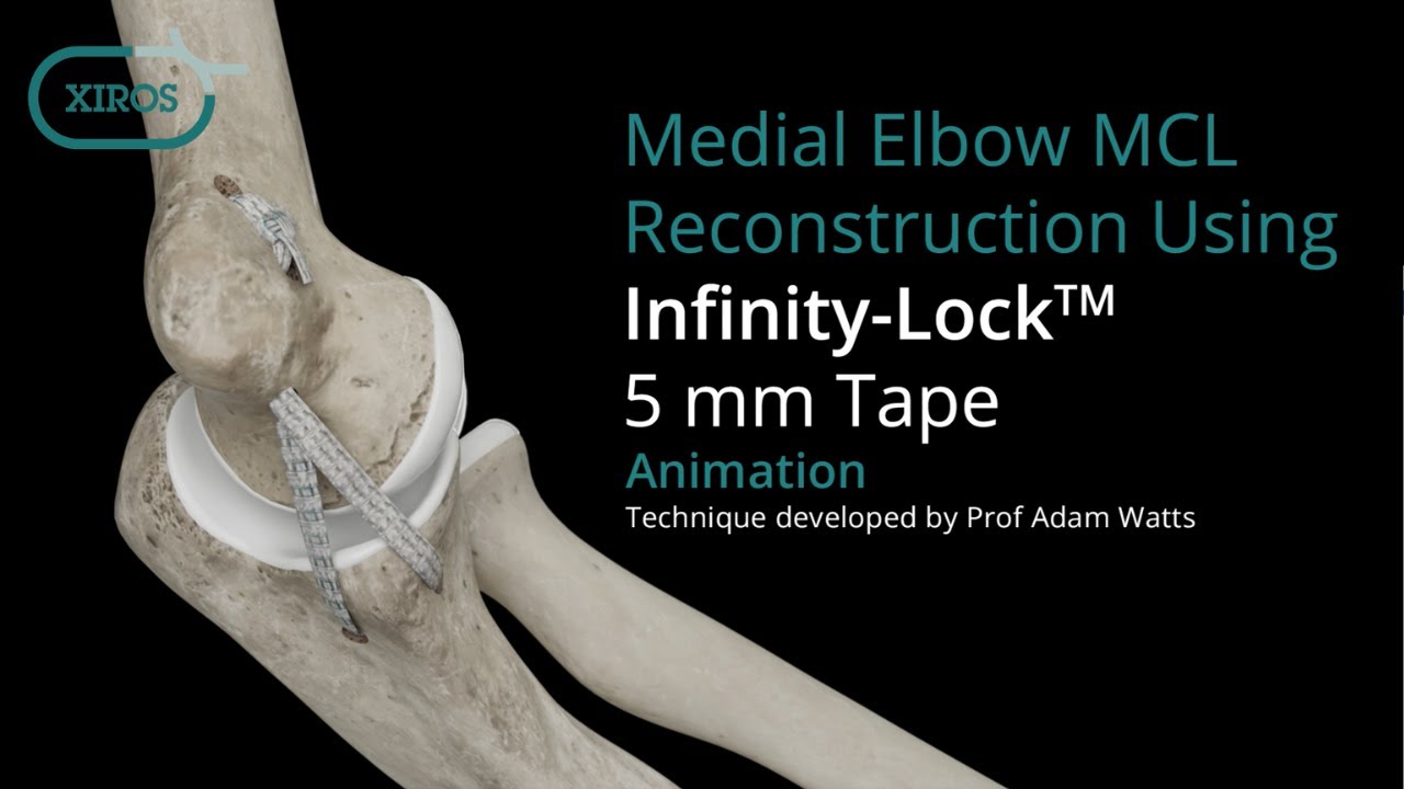 Medial Elbow MCL Reconstruction using Infinity-Lock™ Tape - Surgical ...