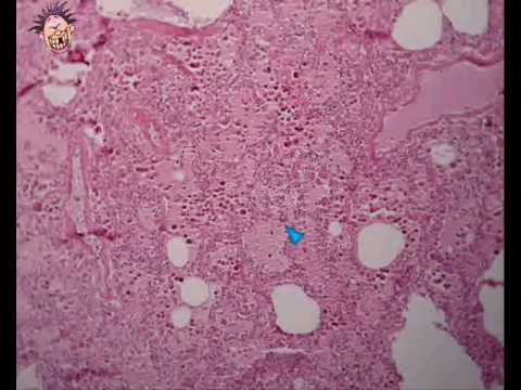 HistoPathology Lung Infarction د عبد الرحمن خليفة - YouTube
