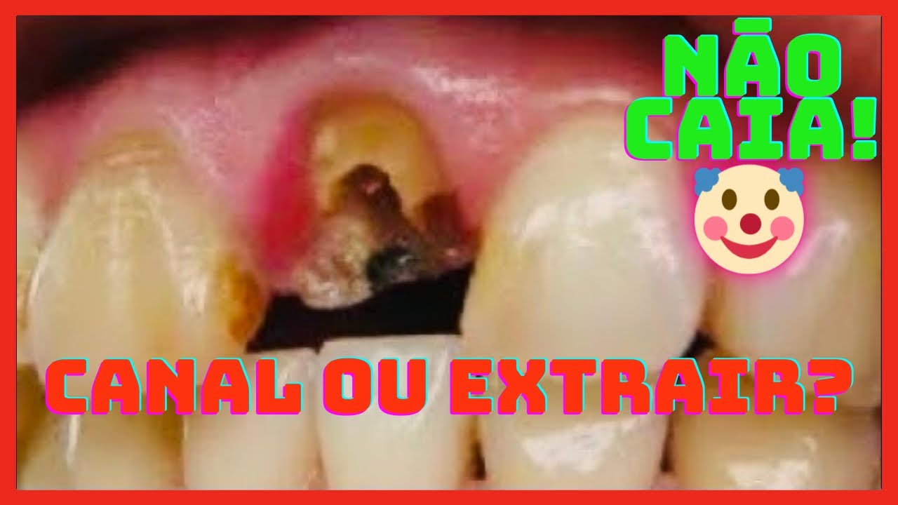 FAZER CANAL ou EXTRAIR o DENTE? NĀO DECIDA SEM VER ESSE VÍDEO ATÉ O ...