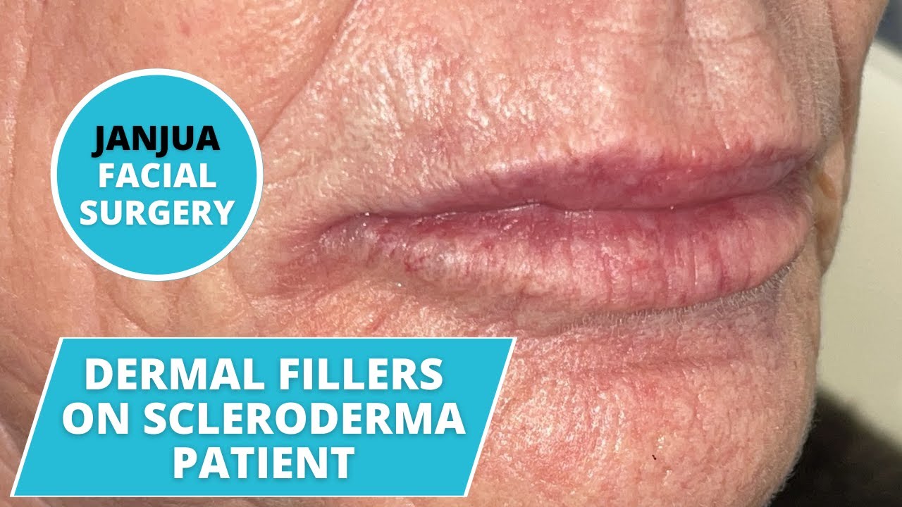DERMAL FILLERS ON SCLERODERMA PATIENT - DR. TANVEER JANJUA - NEW JERSEY ...