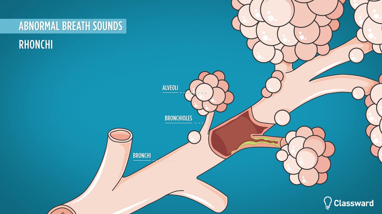 Rhonchi Lung Sounds - YouTube