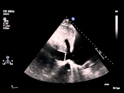 10. Subcostal view of the inferior vena cava (IVC) - YouTube
