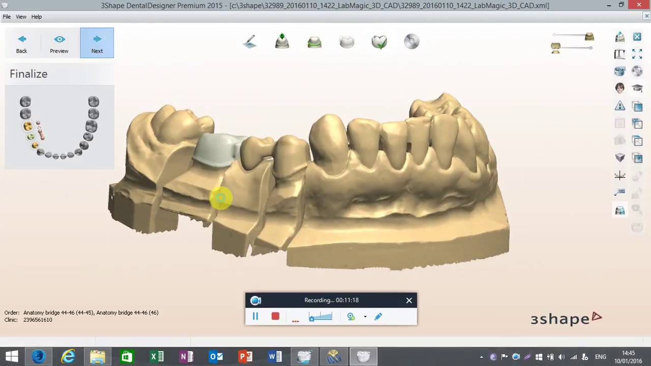 How to split a Dental Frame Bridge in #3Shape - YouTube