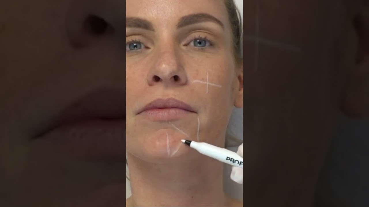 The BAP technique consists in five injection points on each side of the ...