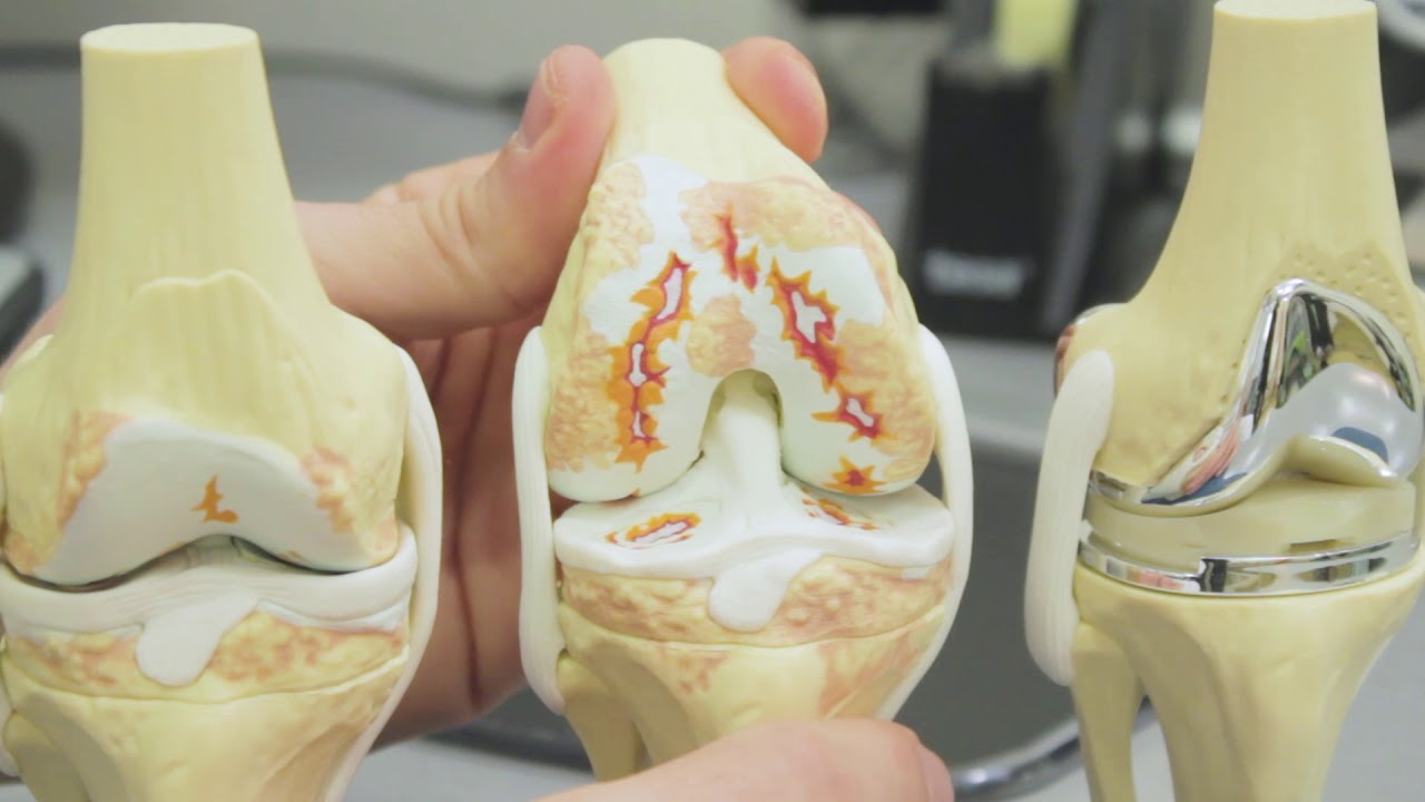 Opis operacije/ugradnje umjetnog koljena na modelu - YouTube