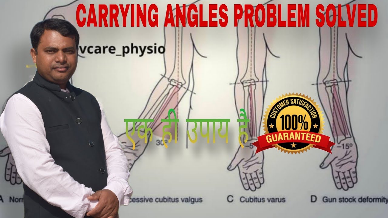 cubitus valgus treatment.carrying angle kese thik kare.#carryingangle # ...
