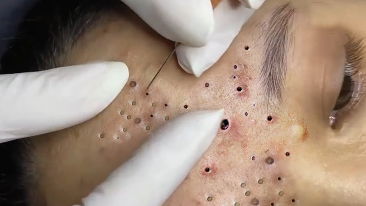 Treatment Of Blackheads And Hidden Acne #016 - YouTube