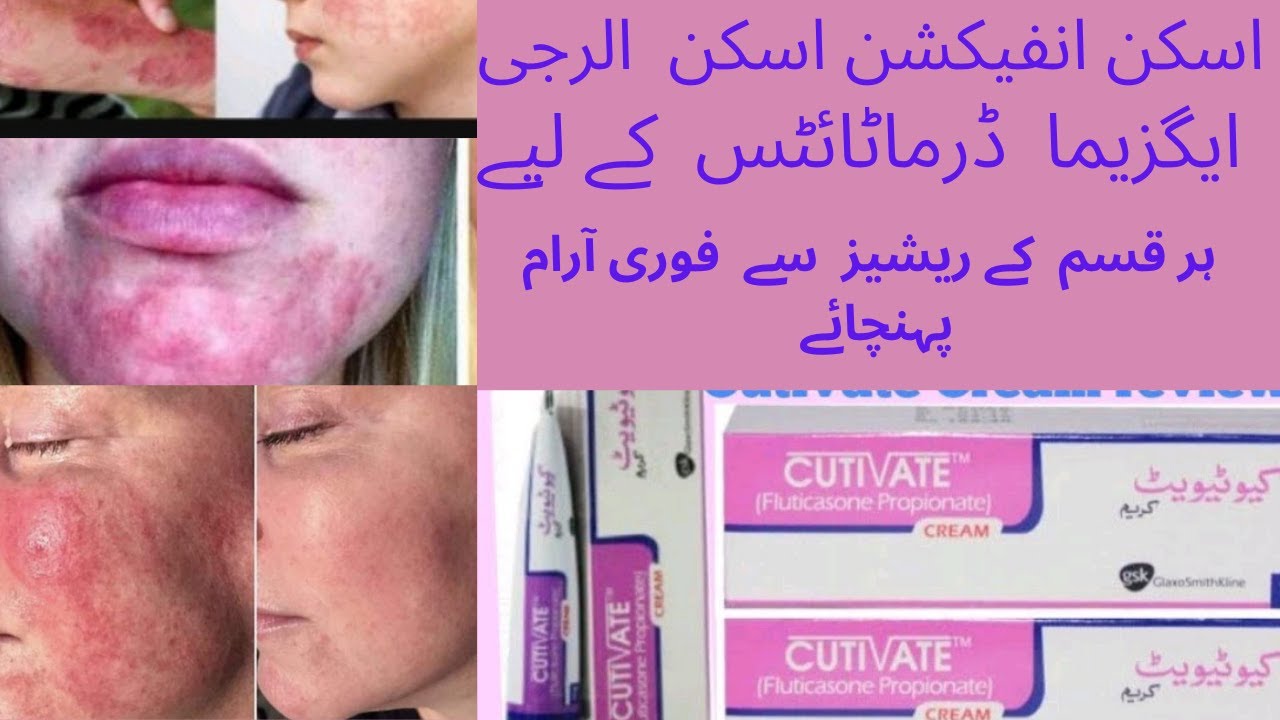 Cutivate cream uses in urdu | Fluticasone propionate | How to uses ...