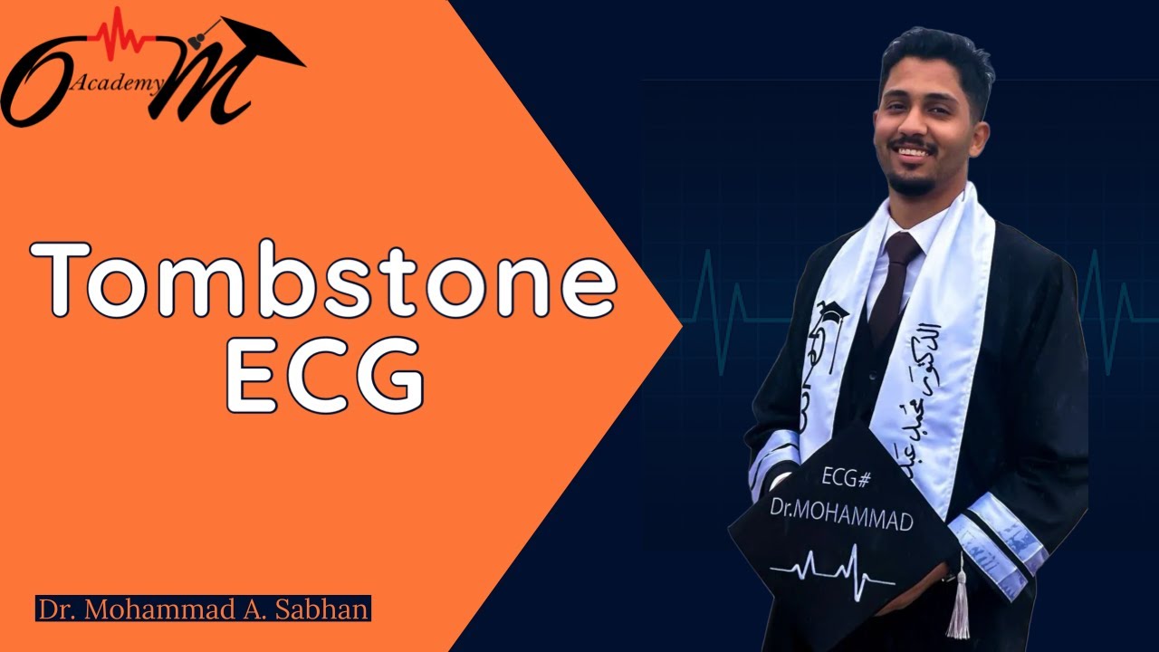 ECG Case - Tombstone ECG - YouTube