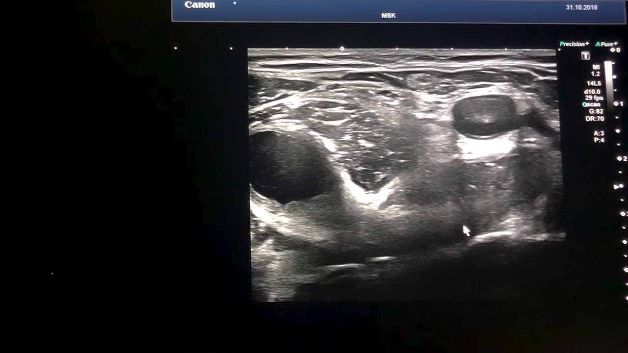 Heup Bursitis - YouTube