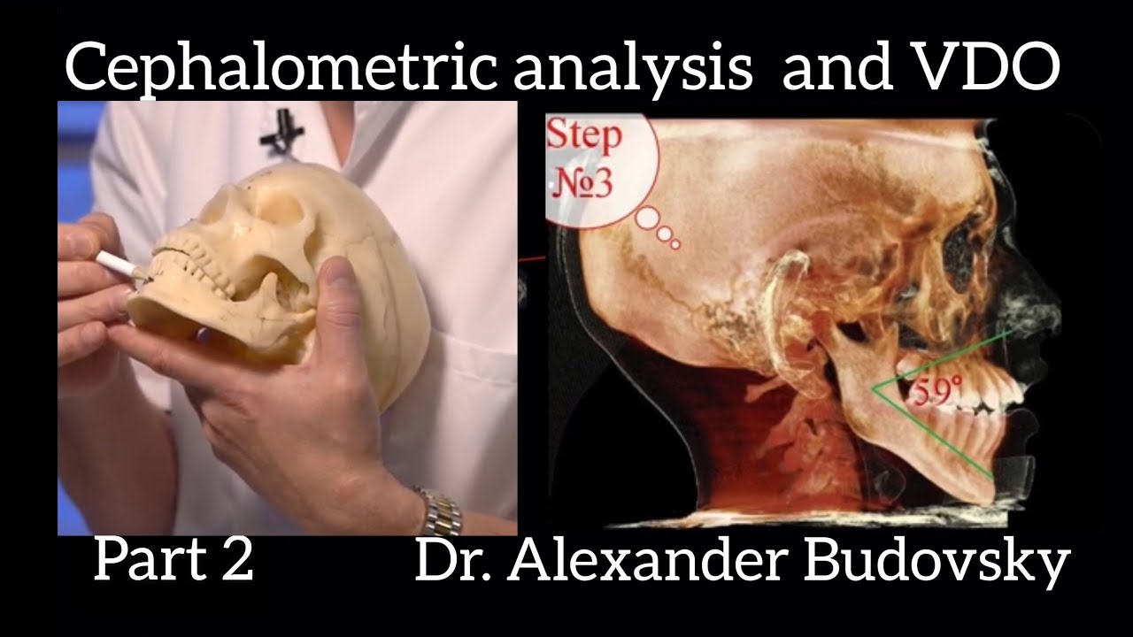 How to Determine Vertical Dimension of Occlusion (VDO, OVD ...
