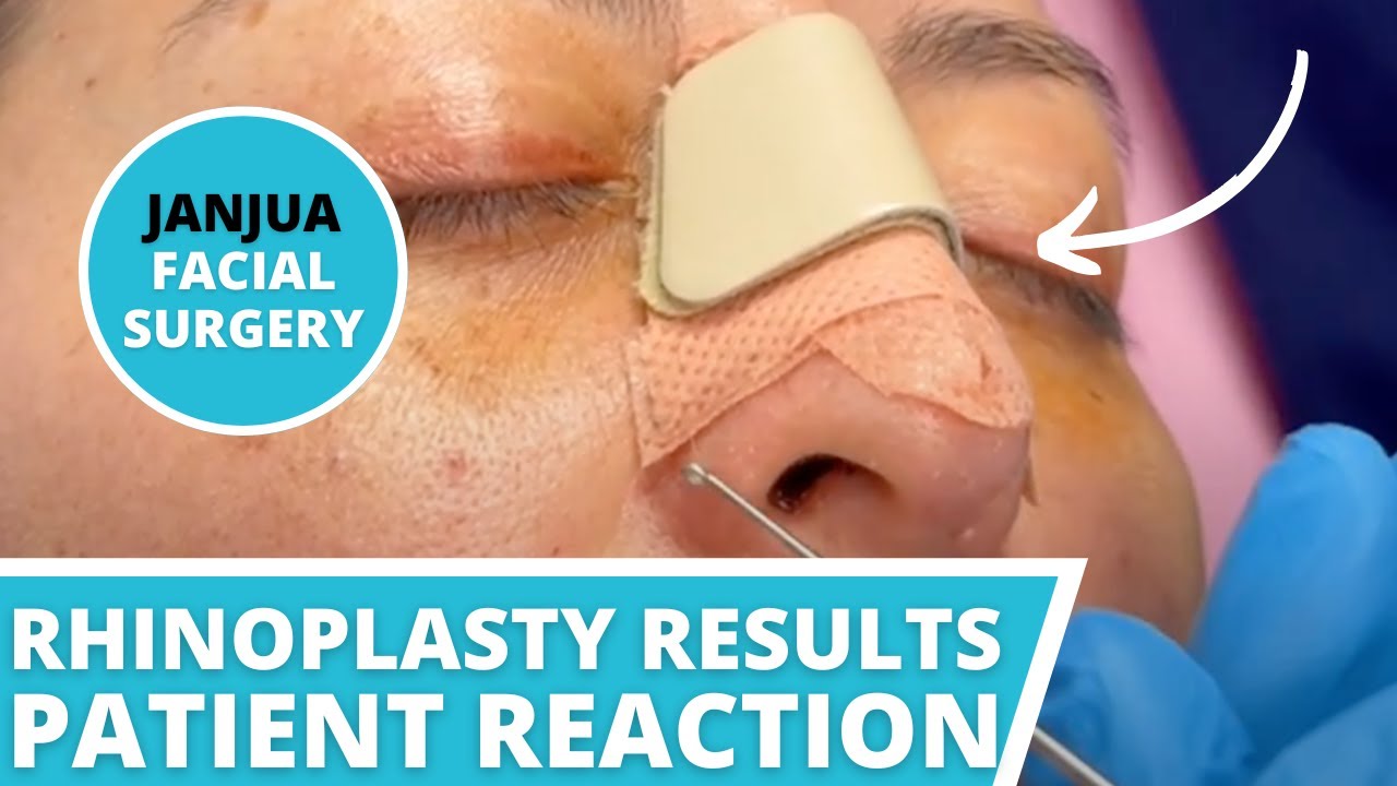 RHINOPLASTY RESULTS (ONE WEEK POST-OP) - DR. TANVEER JANJUA - NEW ...