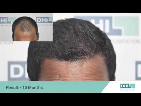 Hasil hair transplant di klinik tanam rambut terbaik di Indonesia dalam ...