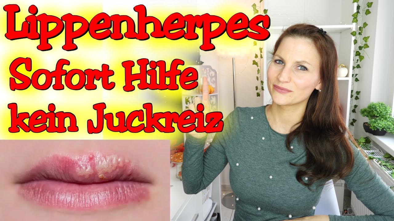 Was Mir WIRKLICH bei Lippenherpes und Fieberbläschen hilft! - YouTube