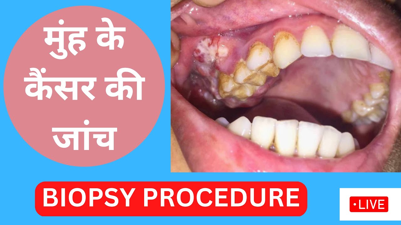 Biopsy Procedure| Muh ke cancer ki janch |Oral cancer|मुंह के कैंसर ...