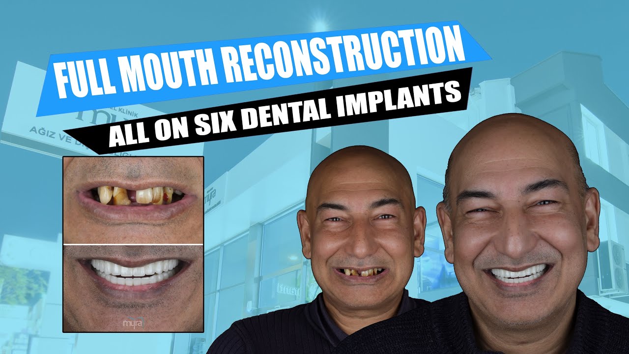 New Teeth, New Smile: Watch Our Patient's Dental Transformation 🦷 ...