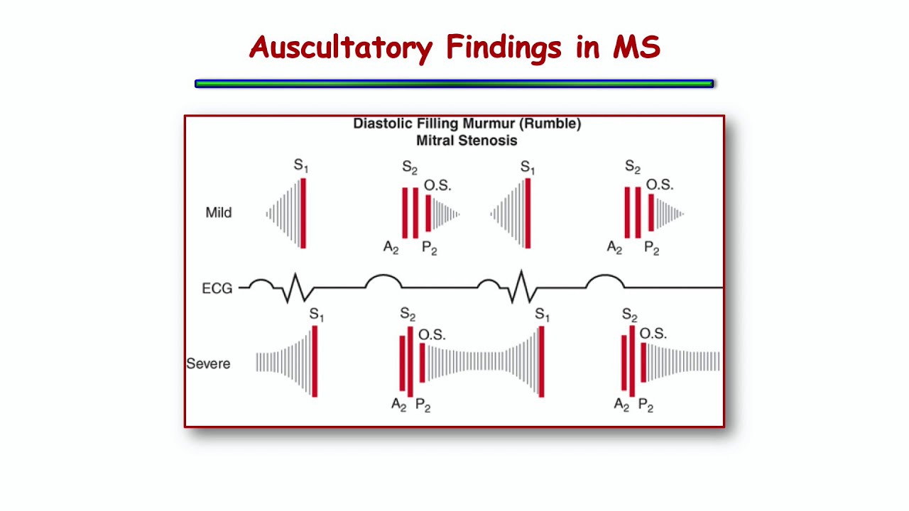 Cardiac Auscultation Made Easy (Diastolic Murmurs), Prof. Khairy Abdel ...