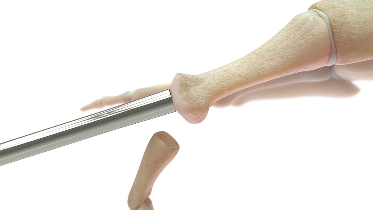 1st MTP Cartiva Synthetic Cartilage Implant Procedure Animated Graphic ...