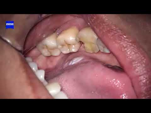 Sharp teeth edges causing multiple ulcers and white patches, diagnosed ...
