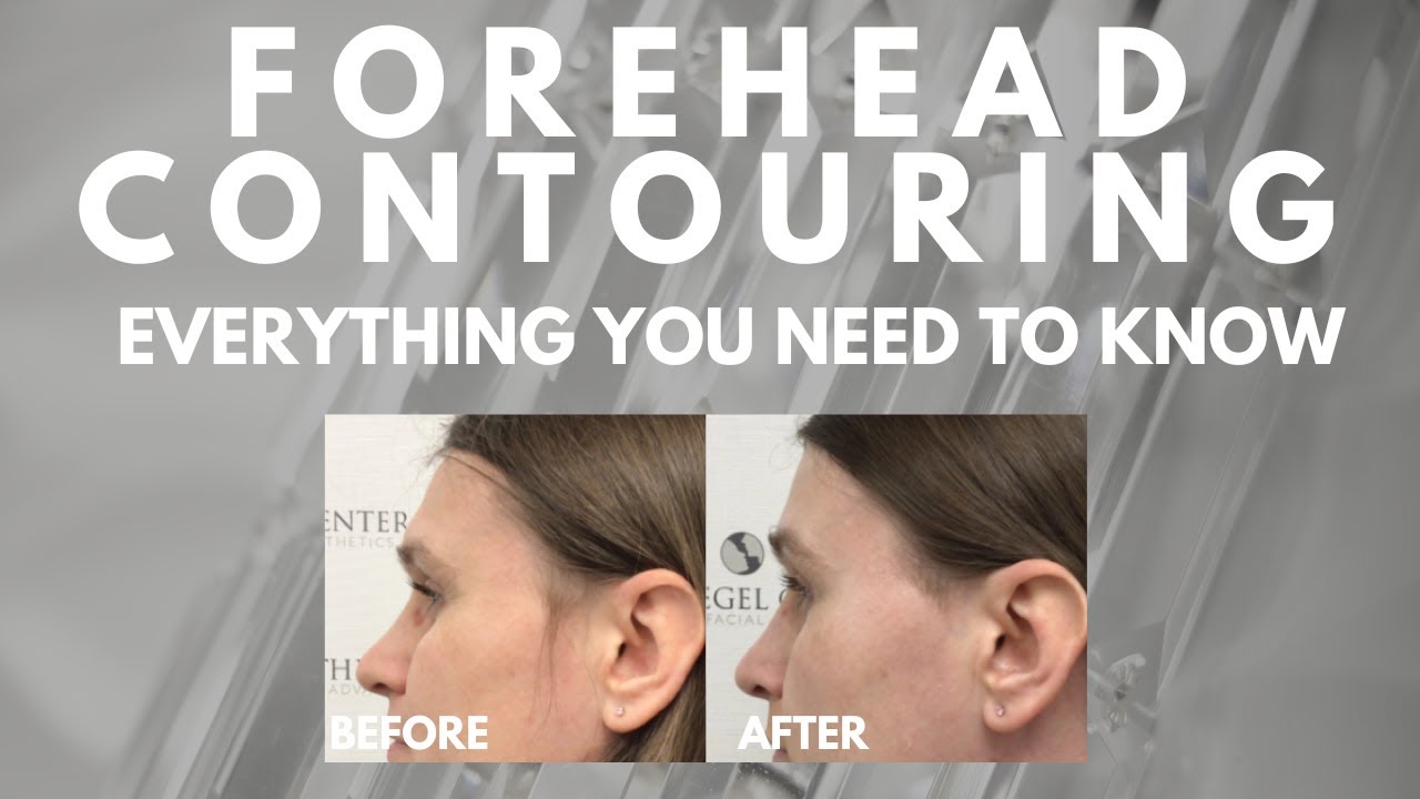 Everything You Need to Know About Forehead Contouring - FFS Surgeon ...