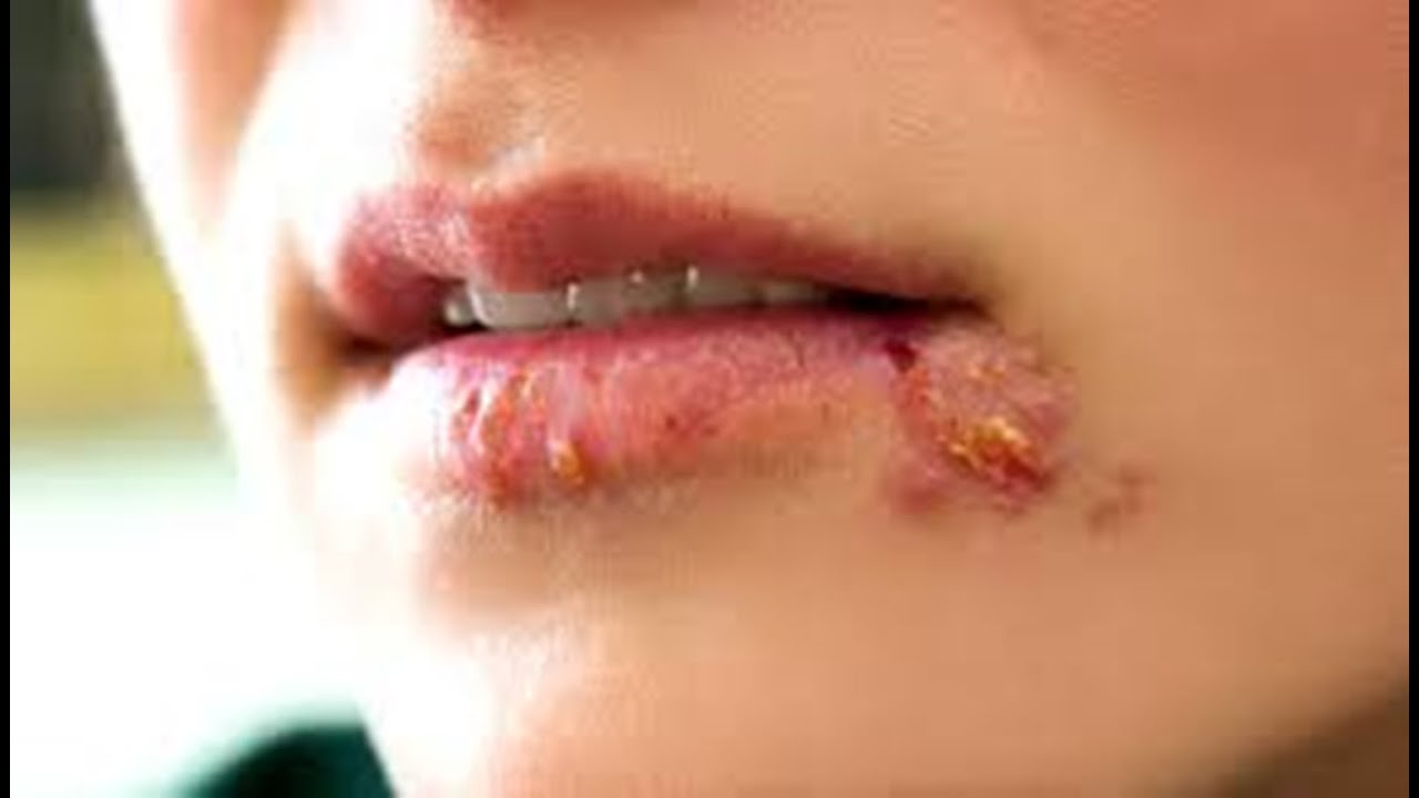 O que pode causar herpes labial? - YouTube