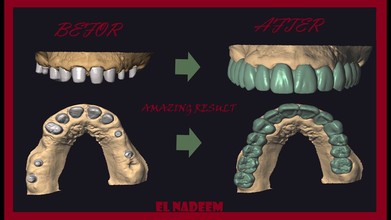 How to desing arch with implant and the canine is omit But in the end ...