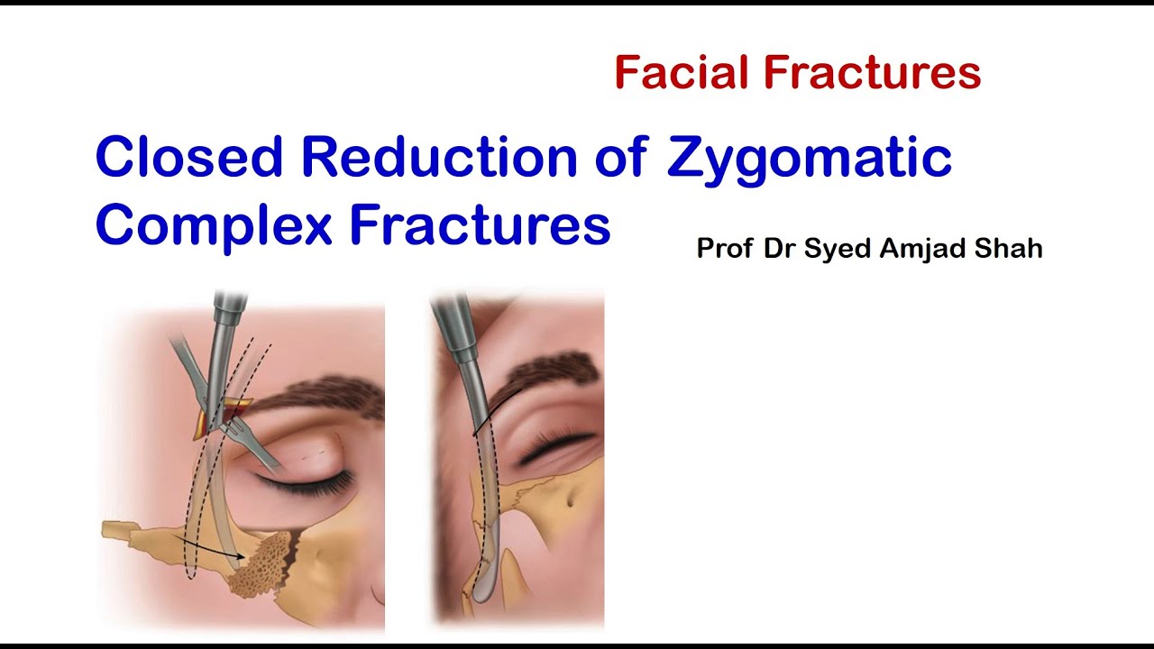 Closed Reduction of Zygomatic Complex Fractures | Oral & Maxillofacial ...
