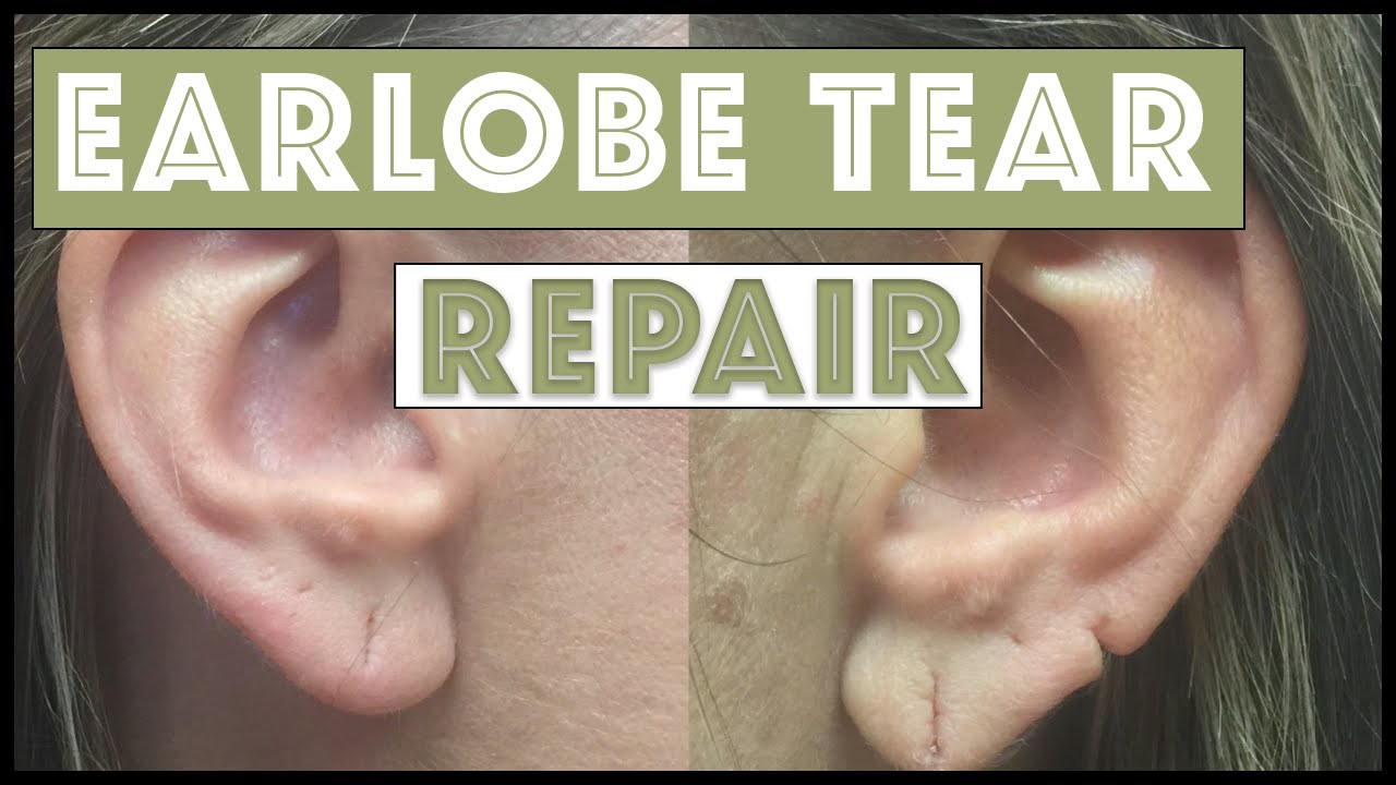 Earlobe Tear Repair - YouTube