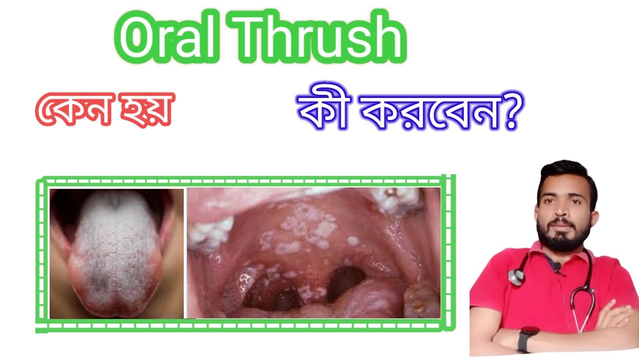 oral Thrush //White Tunge //Fungus //cause and, Treatment and ...