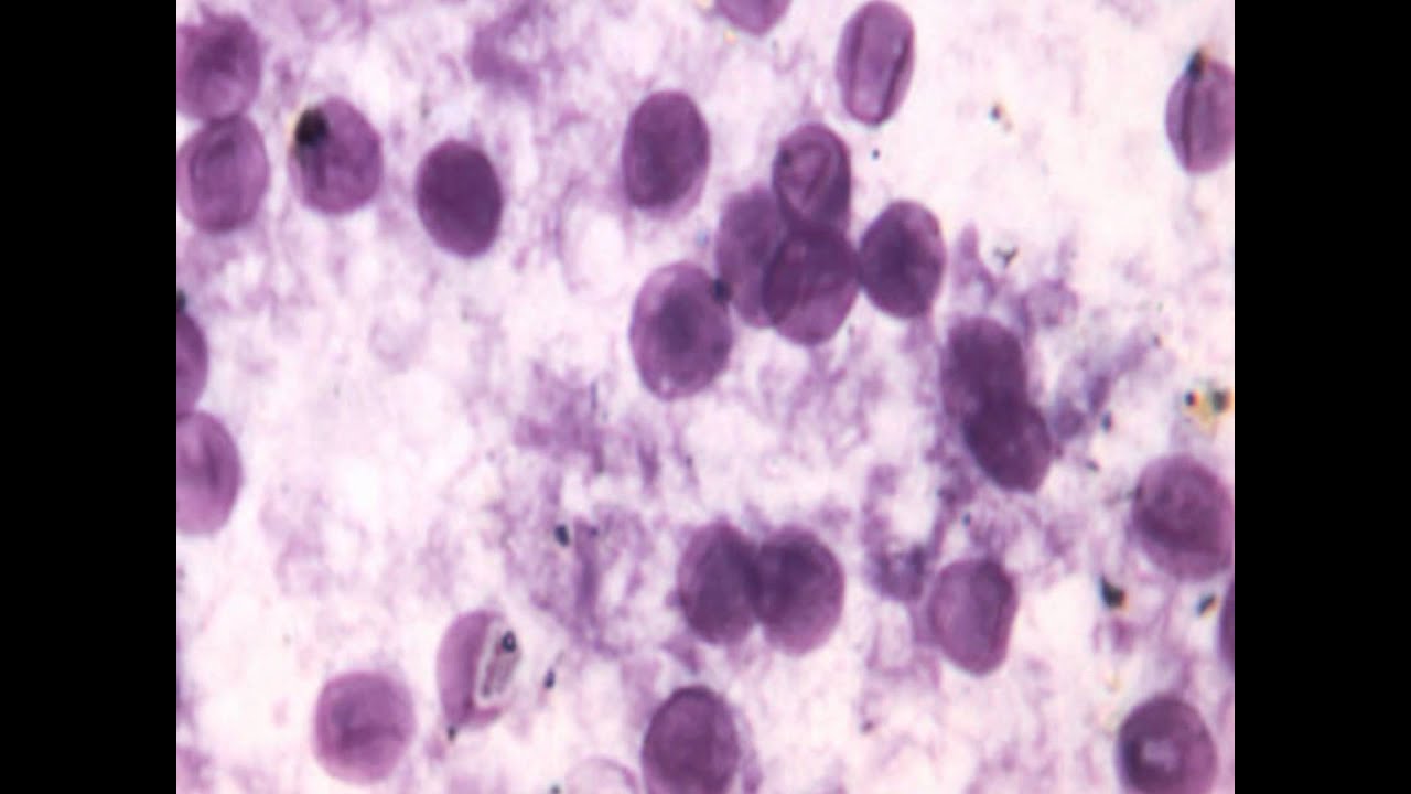 Pneumocystis Pneumonia & Pneumocystis Jirovecii - YouTube