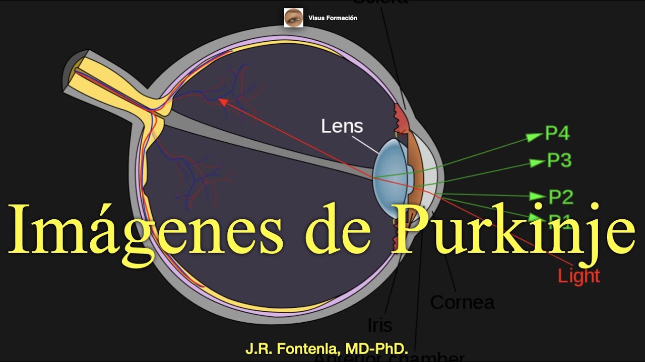 Imágenes de Purkinje. Imágenes de Purkinje-Sanson. - YouTube