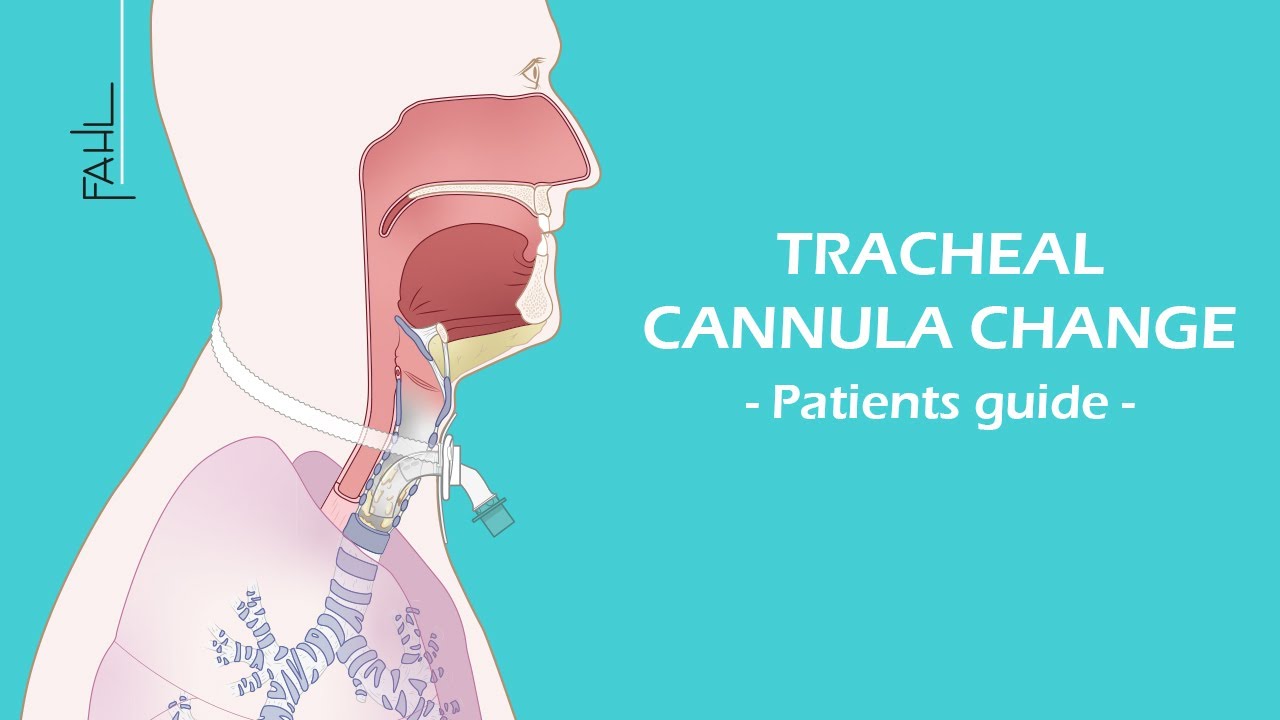 Tracheal cannula change for patients | Animation | Fahl Medizintechnik ...