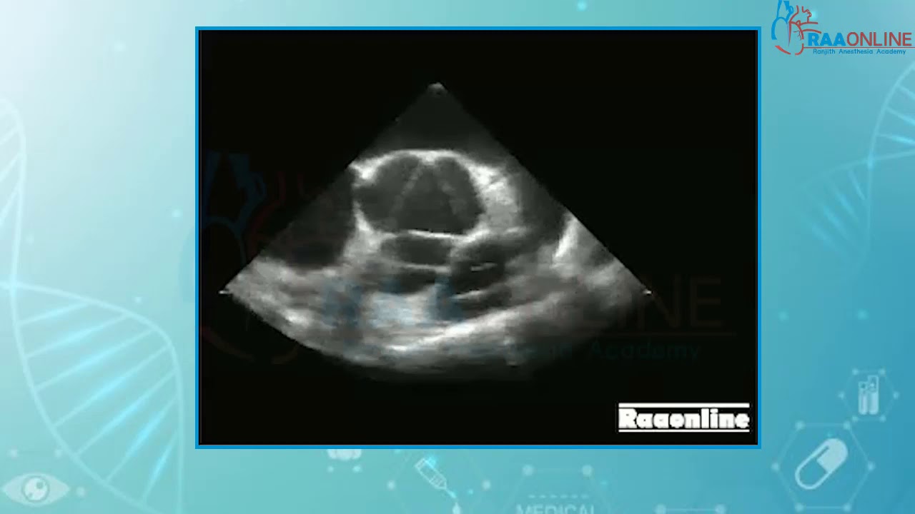 Aortic valve perforation - YouTube