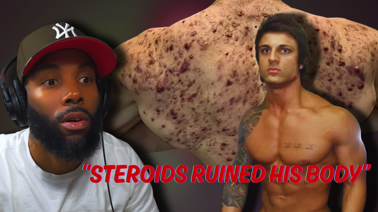 The Worst Steroid Acne You'll Ever See... (REACTION) - YouTube