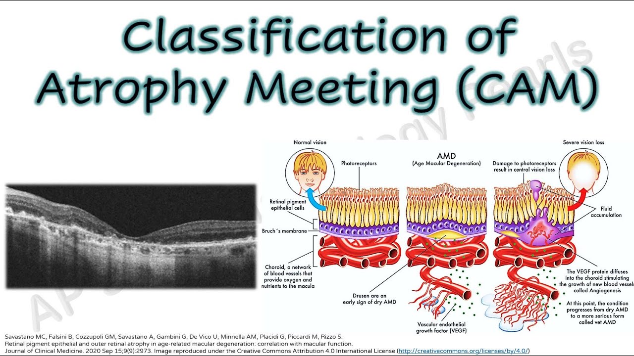 Classification of Atrophy Meeting Reports | Macular Atrophy in AMD ...